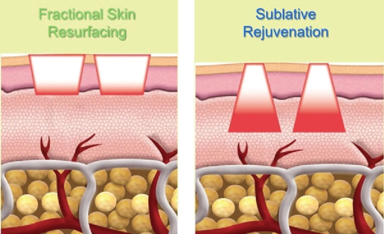 eMatrix: Smooth Skin, Treat Acne Scars—Safe & Affordable!