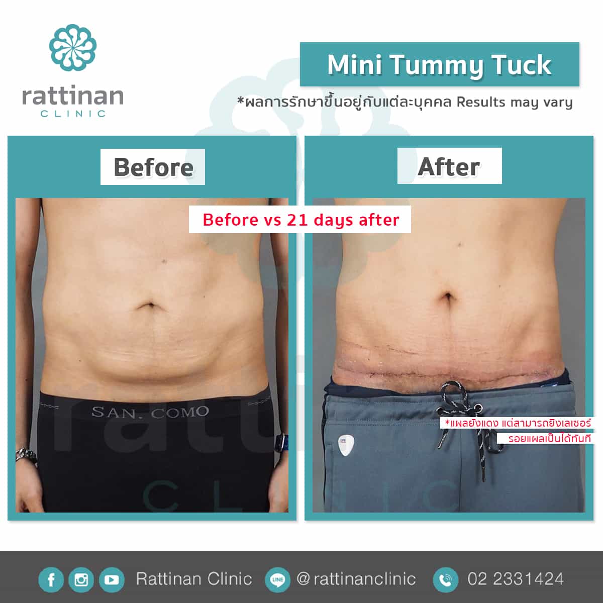 Achieve a Smoother Body with a Tummy Tuck in Bangkok