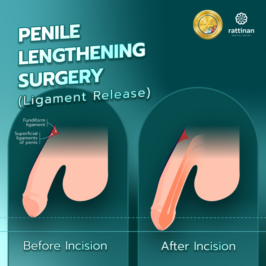 Penis Enlargement Surgery In Bangkok, Thailand