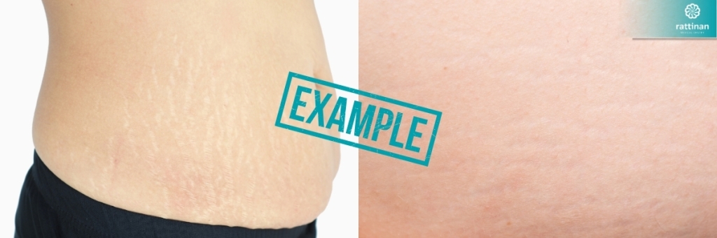 Morpheus NEO : Revitalize Your Skin, Smooth Wrinkles, and Firm Sagging ...