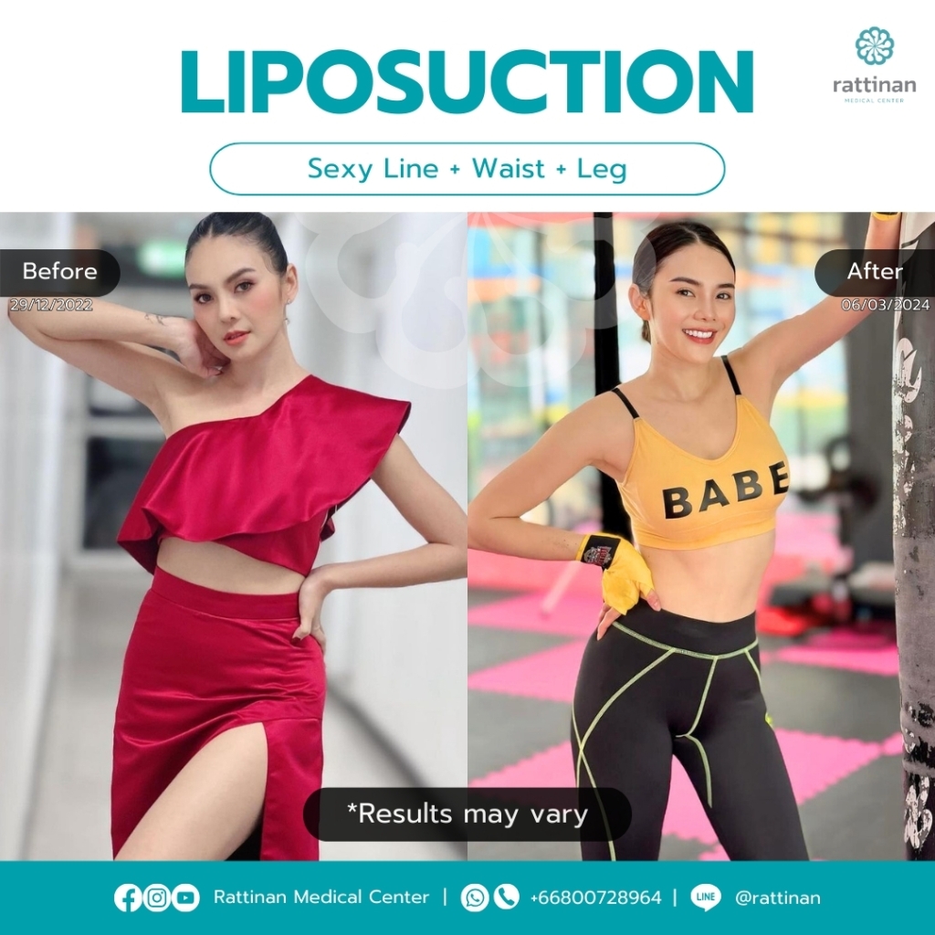 Precision Liposuction in Bangkok to Remove Excess Fat Safely