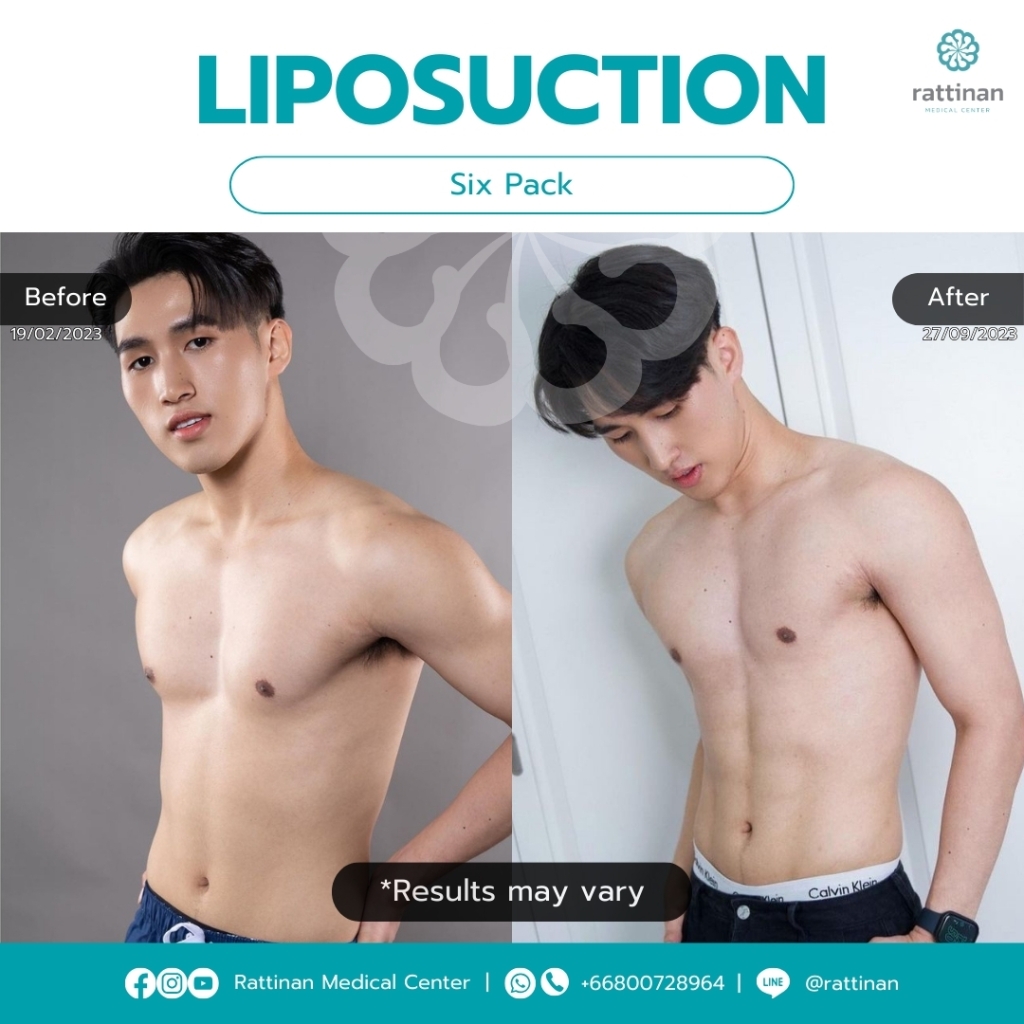 Precision Liposuction in Bangkok to Remove Excess Fat Safely