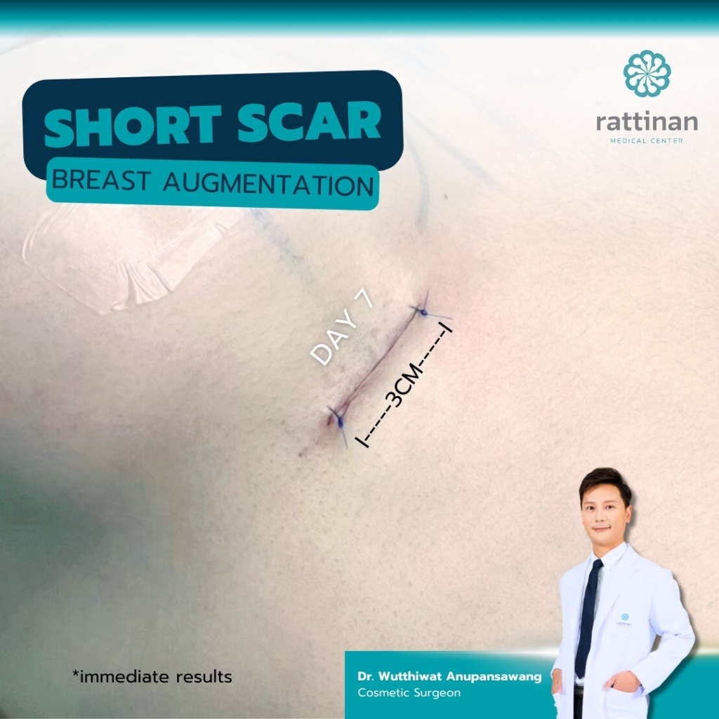 Breast Augmentation in Bangkok at Rattinan Medical Center