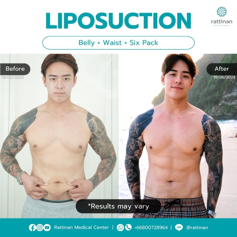 Liposuction in Bangkok to Remove Excess Fat at Rattinan