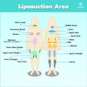 Liposuction in Bangkok, Thailand with Rattinan Medical Center's Expert ...
