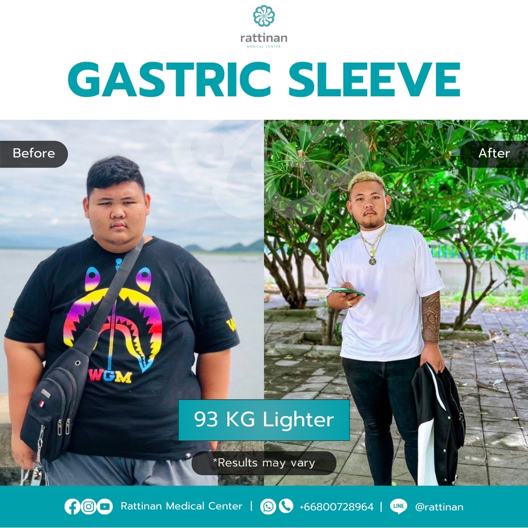 Gastric Sleeve Surgery in Thailand | Rattinan Clinic