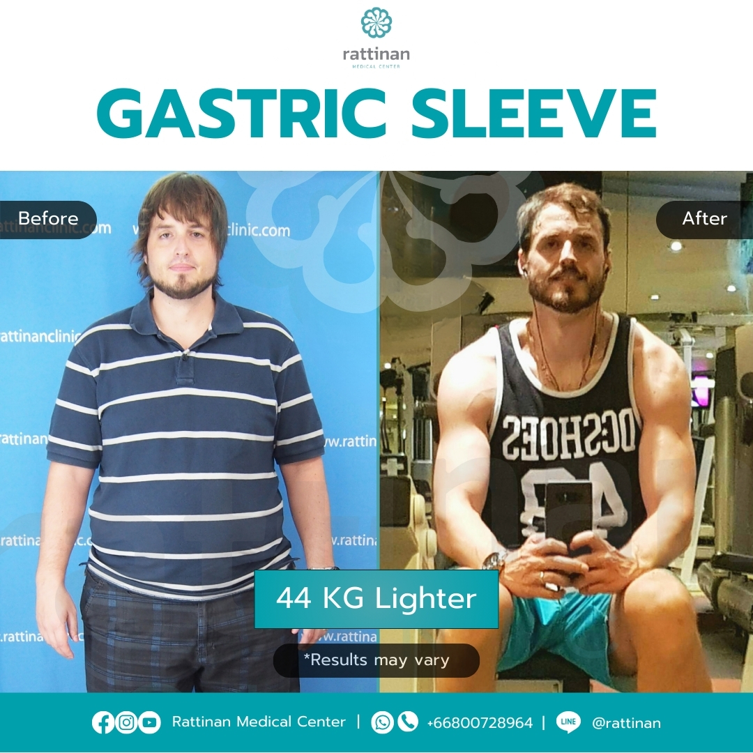 Gastric Sleeve Surgery in Thailand | Rattinan Clinic