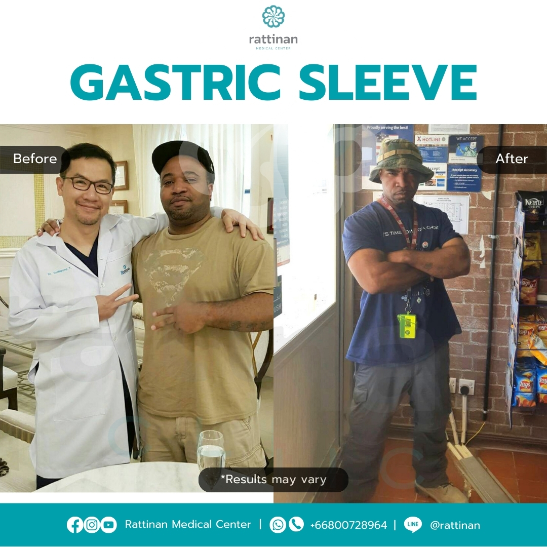Gastric Sleeve Surgery in Thailand | Rattinan Clinic