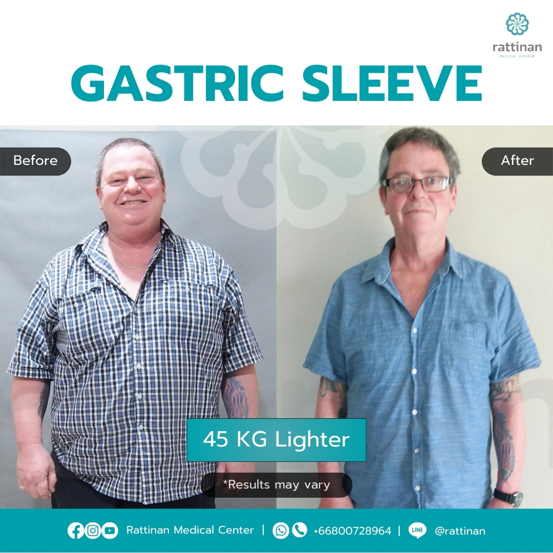 Gastric Sleeve Surgery in Thailand | Rattinan Clinic