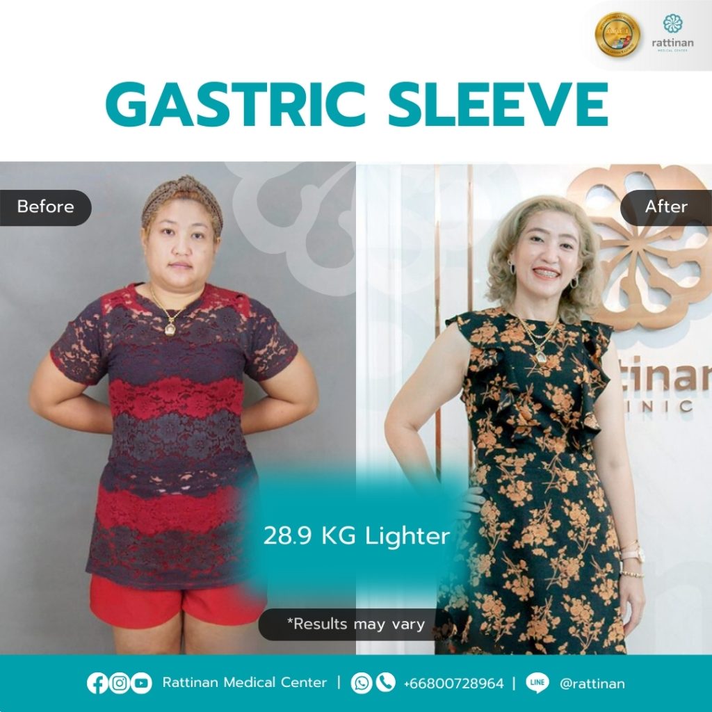Gastric Sleeve Surgery Anxiety Before the Procedure