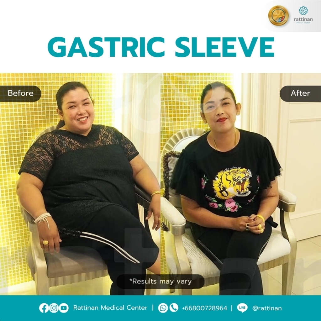 Gastric Sleeve Surgery Anxiety Before the Procedure