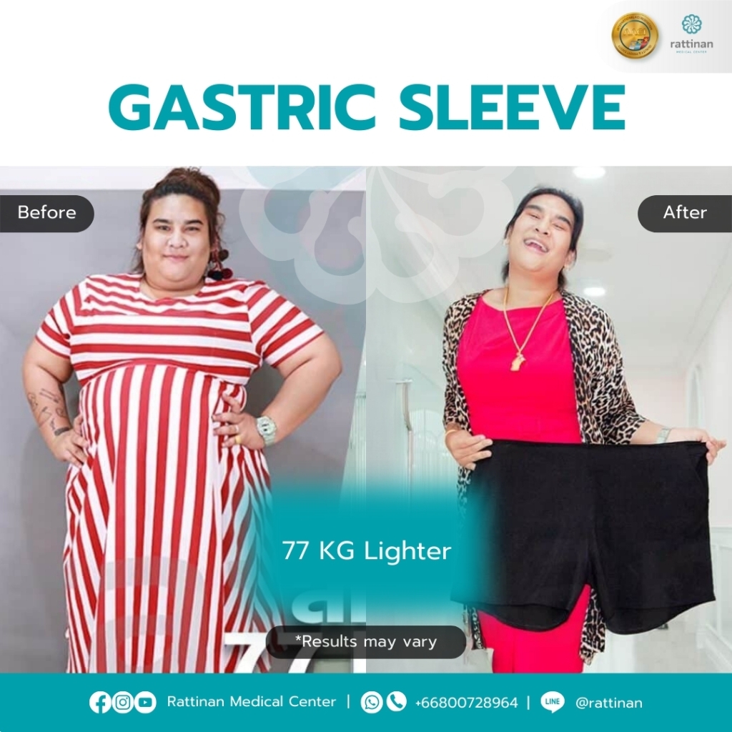 Gastric Sleeve Surgery Anxiety Before the Procedure
