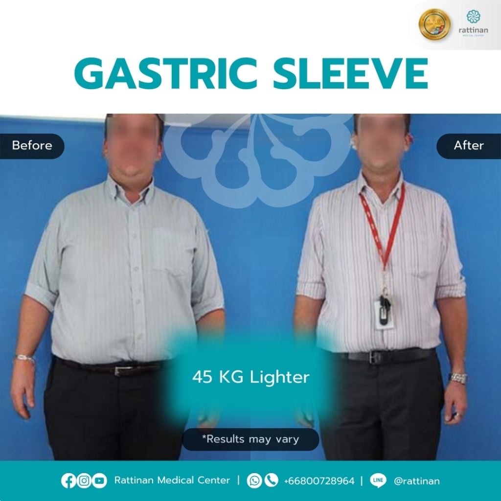 Gastric Sleeve Surgery Anxiety Before the Procedure