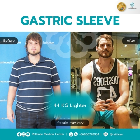 Gastric Sleeve Surgery Anxiety Before the Procedure