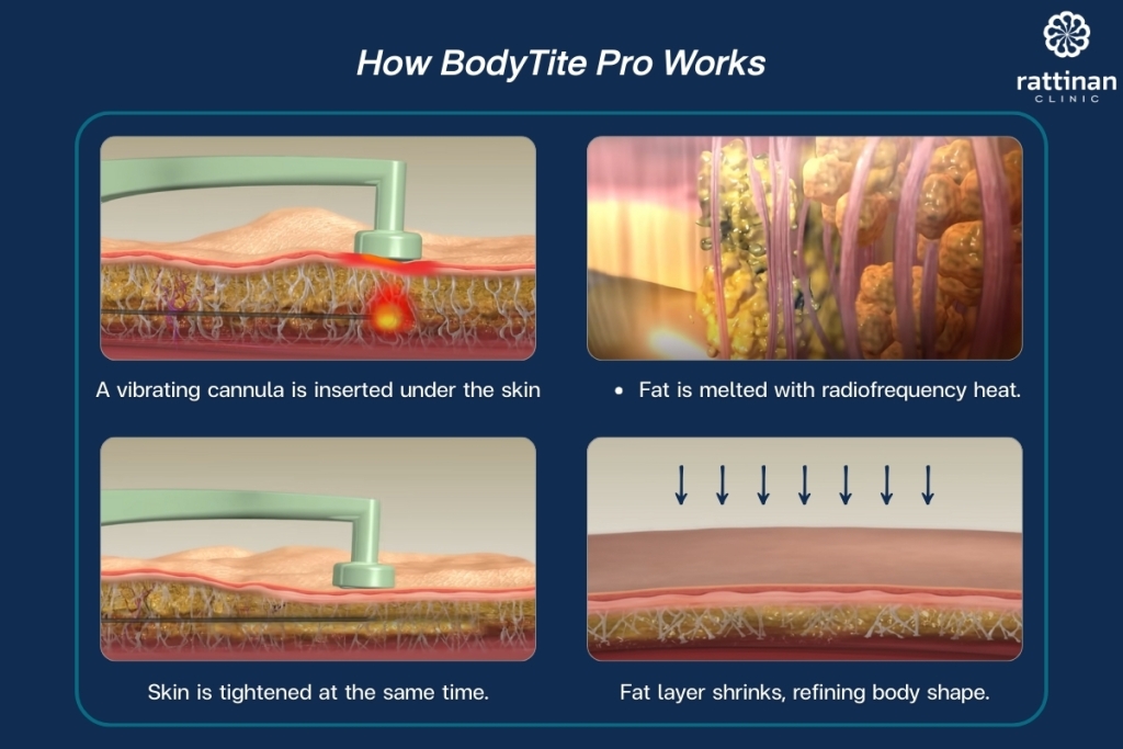 BodyTite Pro for Fat Removal and Skin Tightening | Rattinan Clinic