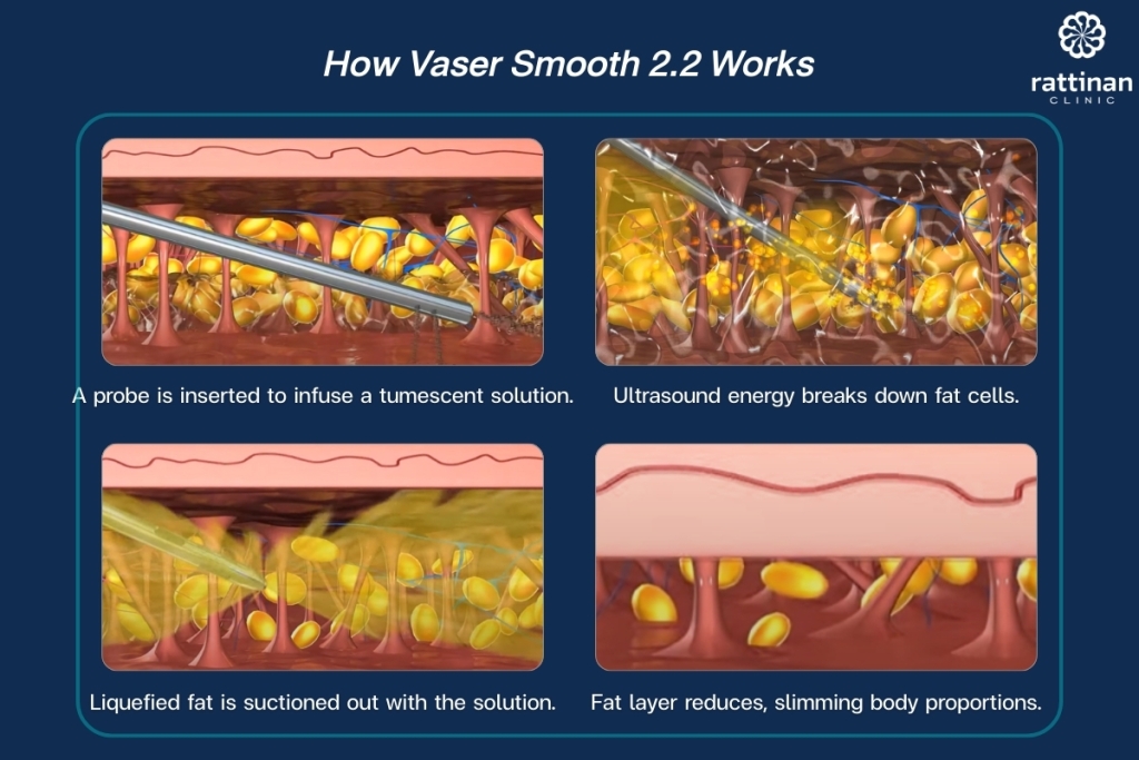 How Does Liposuction Work | Rattinan Clinic