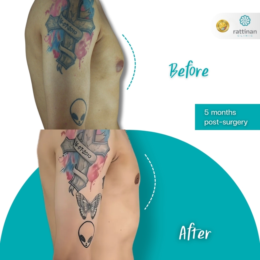 Gynecomastia Surgery Before and After at Rattinan Clinic