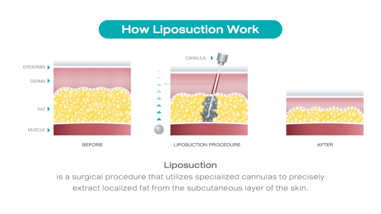 Precision Liposuction in Bangkok to Remove Excess Fat Safely