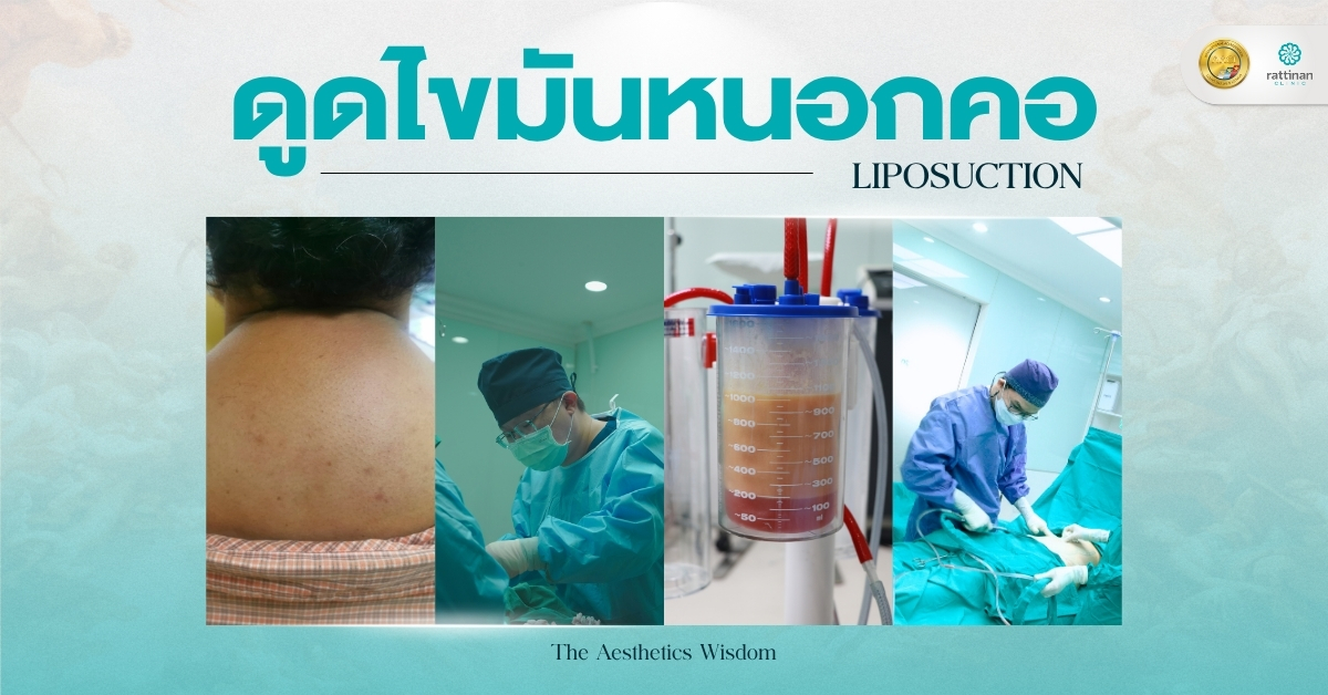 ดูดไขมันหนอกคอ (Buffalo Hump) กำจัดก้อนไขมันที่ท้ายทอย