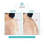 ดูดไขมันหนอกคอ (Buffalo Hump) ลดไขมันส่วนเกินต้นคอ โดยอาจารย์แพทย์สอน ...