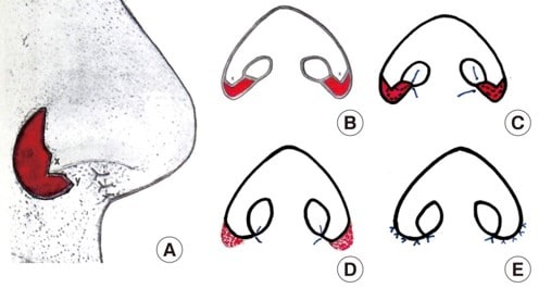 ตัดปีกจมูก คืออะไร? วิธีแก้ปัญหาจมูกบานให้ใบหน้าดูสมส่วนขึ้น