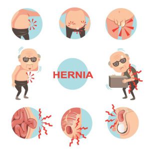 ไส้เลื่อน (hernia) คืออะไร หากเป็นแล้วต้องรักษาอย่างไร?