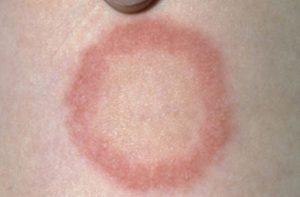 สังคัง (Tinea Cruris) เกิดจากอะไร รักษาให้หายขาดได้หรือไม่?