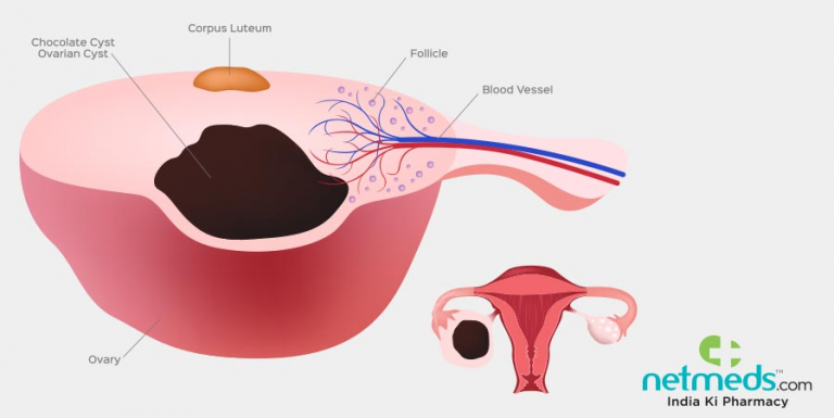 ถุงน้ำรังไข่ (Ovarian cyst) เกิดจากอะไร อันตรายไหม ควรรักษาอย่างไร?