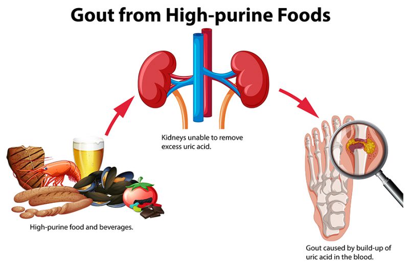โรคเก๊าท์ (Gout) เกิดจากอะไร รักษาอย่างไร และควรเลี่ยงอาหารประเภทไหน?