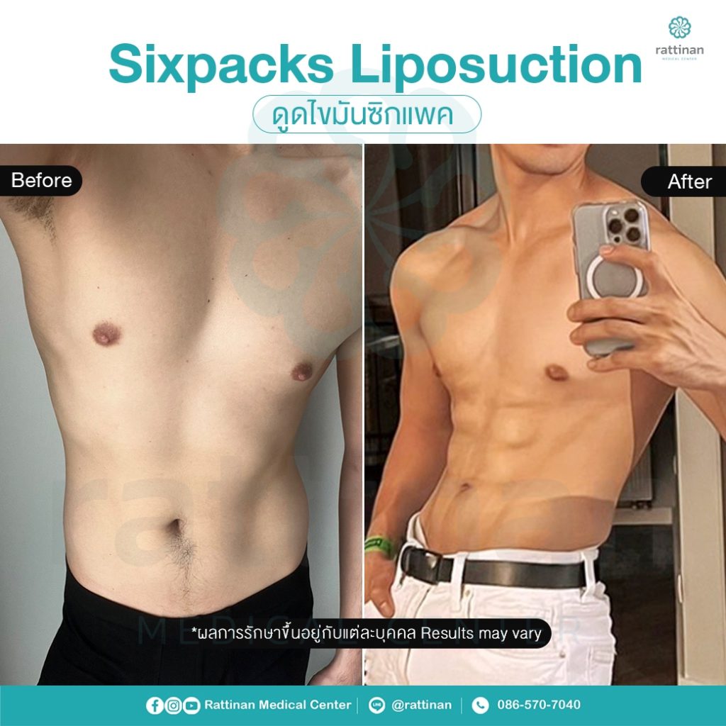 หุ่นลีน คืออะไร? ทำยังไงถึงมีหุ่นลีน หน้าท้องลีน