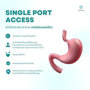 ผ่าตัดกระเพาะอาหารแบบแผลเดียว (Single Port Access) ทำอย่างไร?