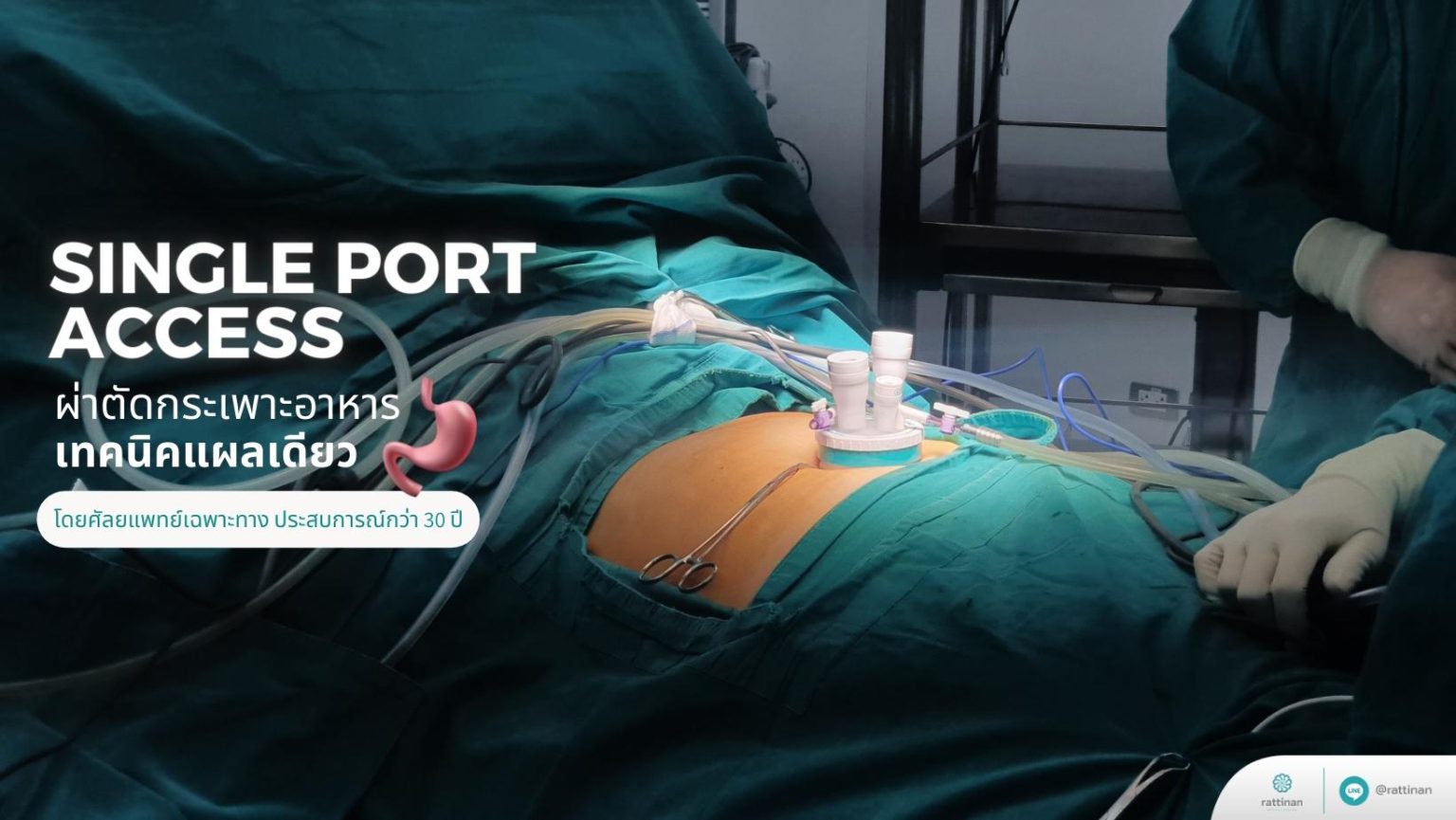 ผ่าตัดกระเพาะอาหารแบบแผลเดียว (Single Port Access) ทำอย่างไร?