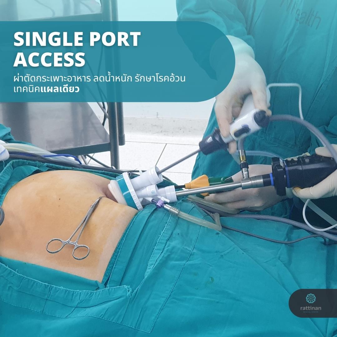 ผ่าตัดกระเพาะอาหารแบบแผลเดียว (Single Port Access) ทำอย่างไร?