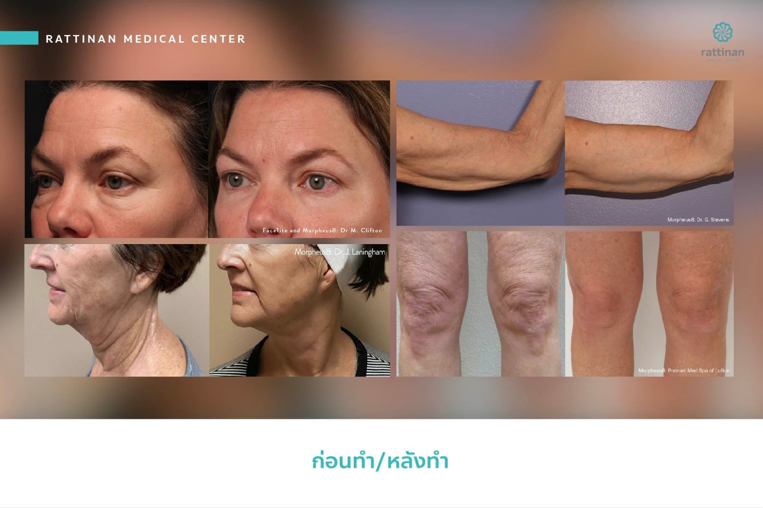 ความแตกต่างระหว่าง Morpheus 8 vs Ultherapy vs Thermage