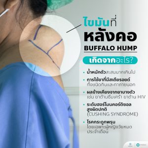 ดูดไขมันหนอกคอ (Buffalo Hump) กำจัดก้อนไขมันที่ท้ายทอย