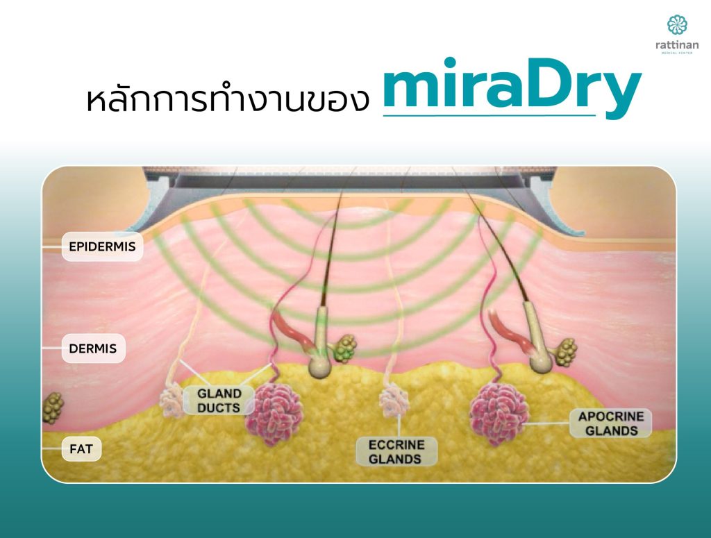 miraDry เลเซอร์ต่อมเหงื่อ ลดกลิ่นตัว ไม่เจ็บ ไม่ต้องผ่าตัด