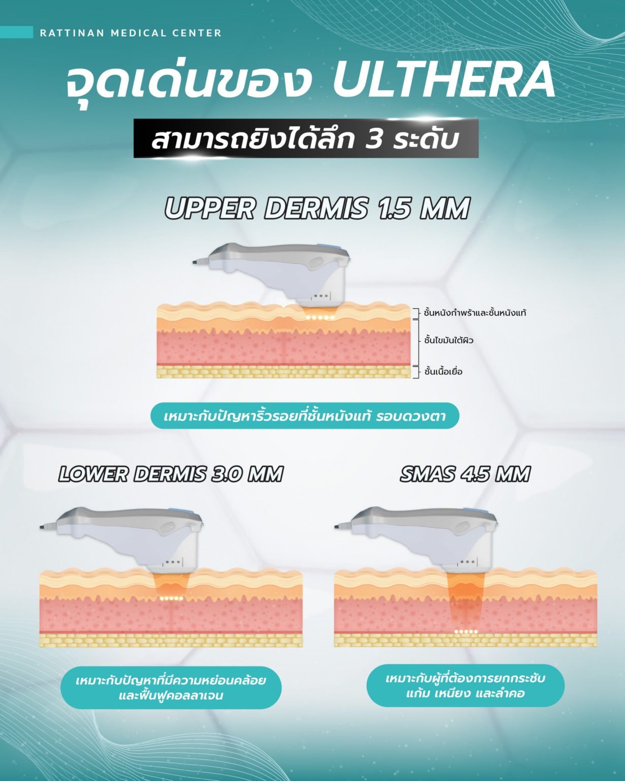 เทียบการยกกระชับหน้า Emface vs Ulthera vs Thermage vs Morpheus8 อะไรดีกว่า