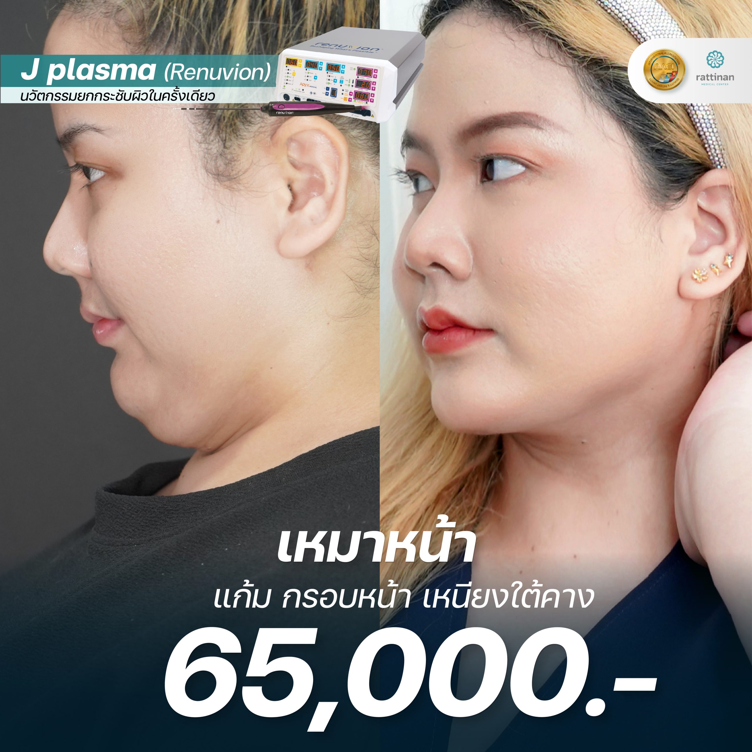 J-Plasma ยุคใหม่ของการยกกระชับผิว รับมือผิวหย่อนคล้อยได้อย่างไร้กังวล