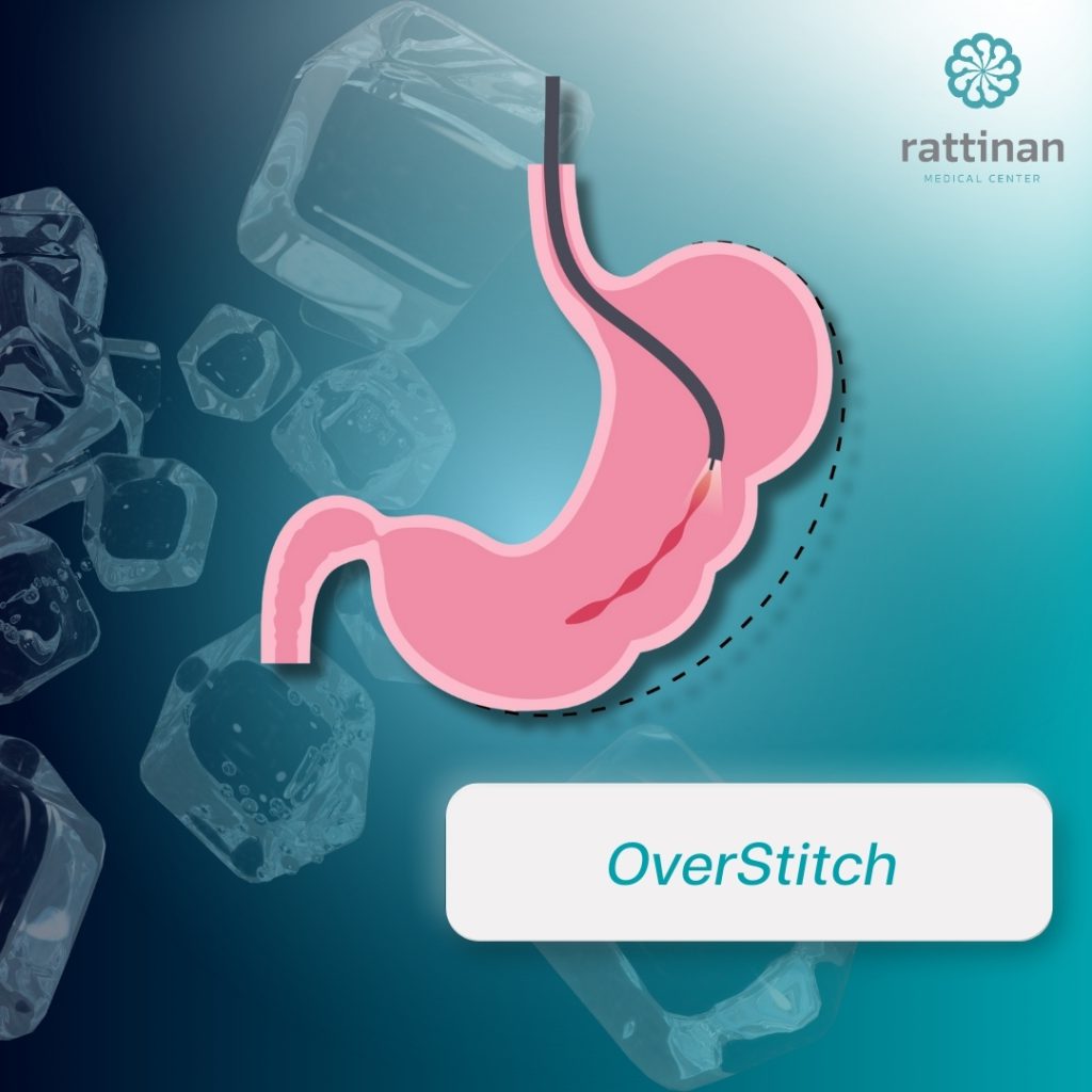 OverStitch เย็บกระเพาะอาหารส่องกล้อง รักษาโรคอ้วนไม่ต้องผ่าตัด