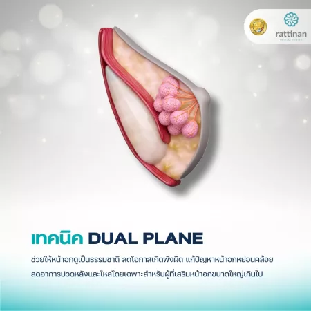 แก้หน้าอก ลดขนาดหน้าอก ด้วยเทคนิค Dual Plane